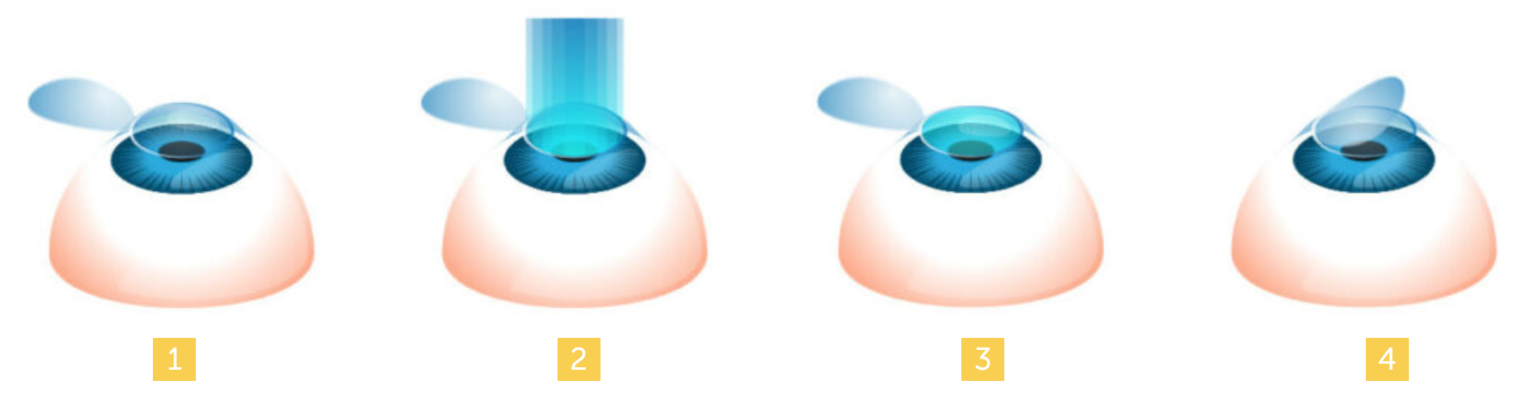 LASIK Eye Surgery in Phoenix | Desert Vista Eye